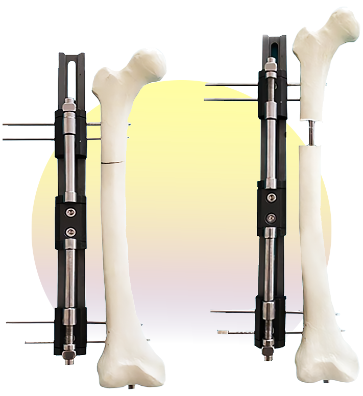 To Be Taller - Limb Lengthening Clinic